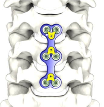 Cygnus Anterior Cervical Plate System - Amp Surgical
