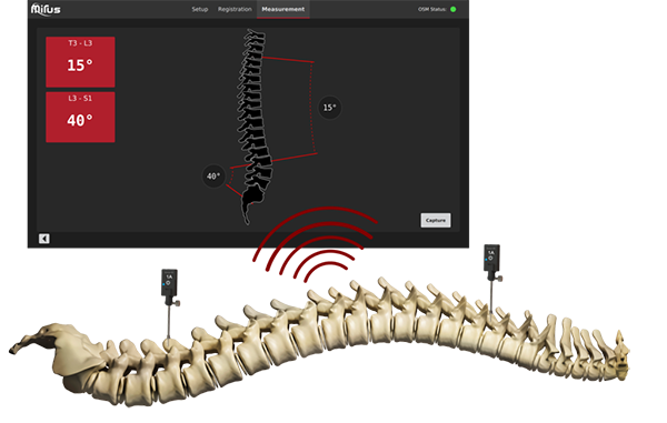 Galileo Spine Alignment Monitoring System - Amp Surgical